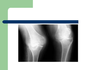 Charcot Joint Knee
