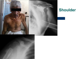 Charcot Joint Shoulder