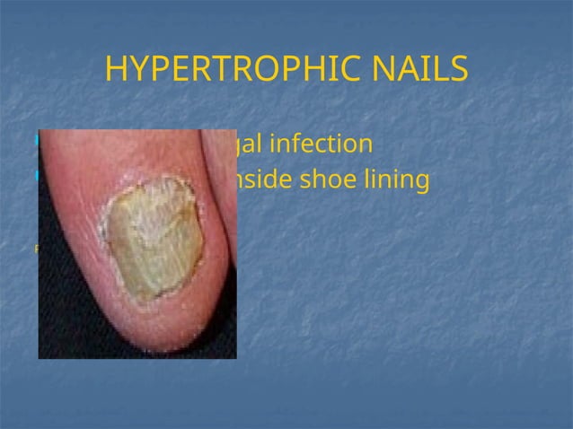 Neuropathic ulcers and diabetic foot ulcer | PPTX