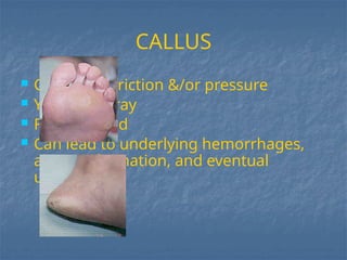 Neuropathic ulcers and diabetic foot ulcer | PPTX