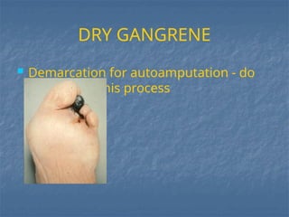 Neuropathic ulcers and diabetic foot ulcer | PPTX