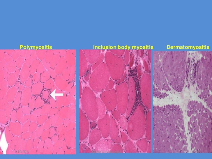 Neuropathies & myopathies - an overview