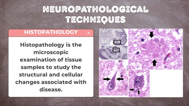 UNDERSTANDING WHAT IS NEUROPATHOLOGY.pptx