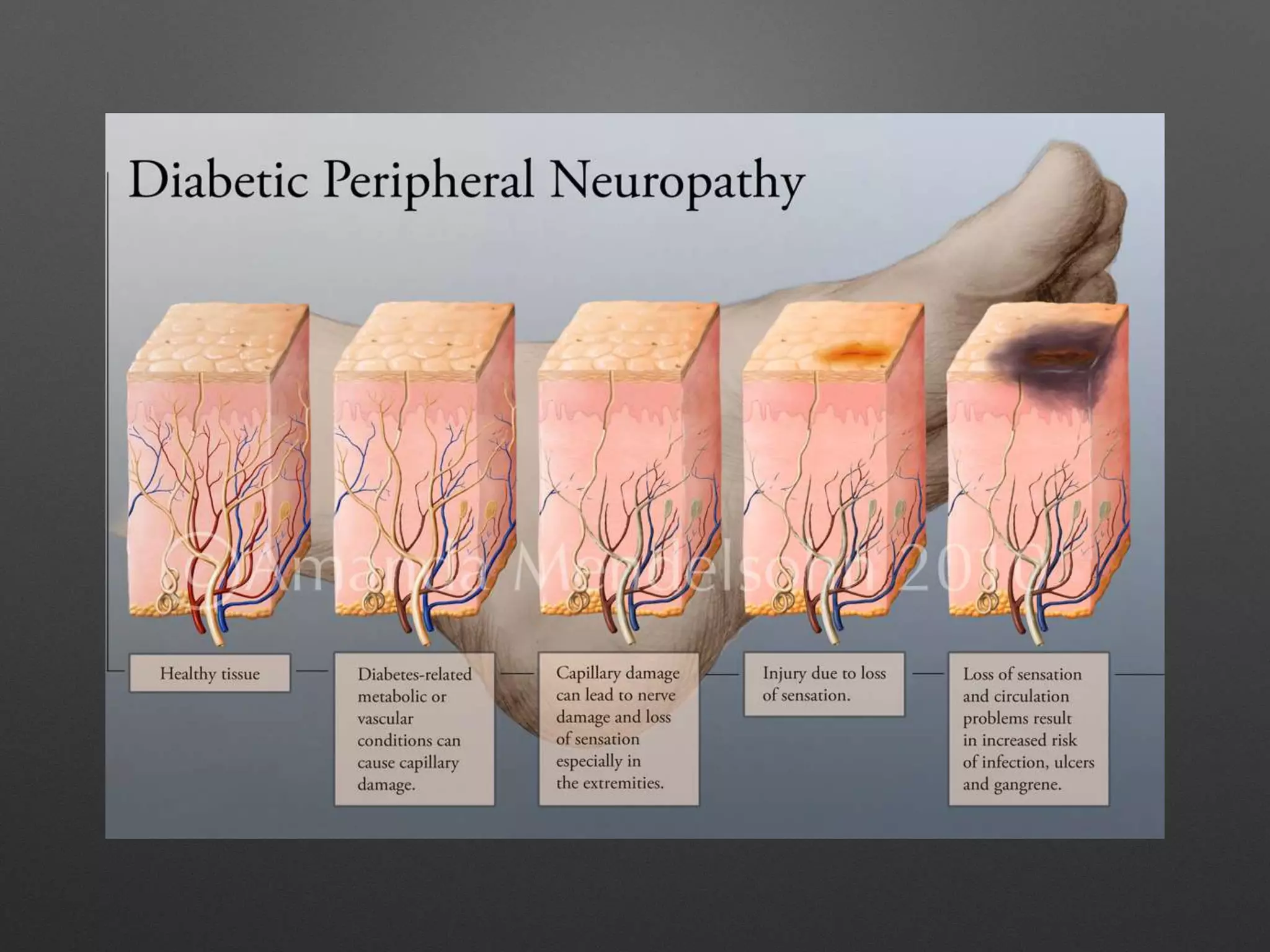 Neuropathies | PPTX