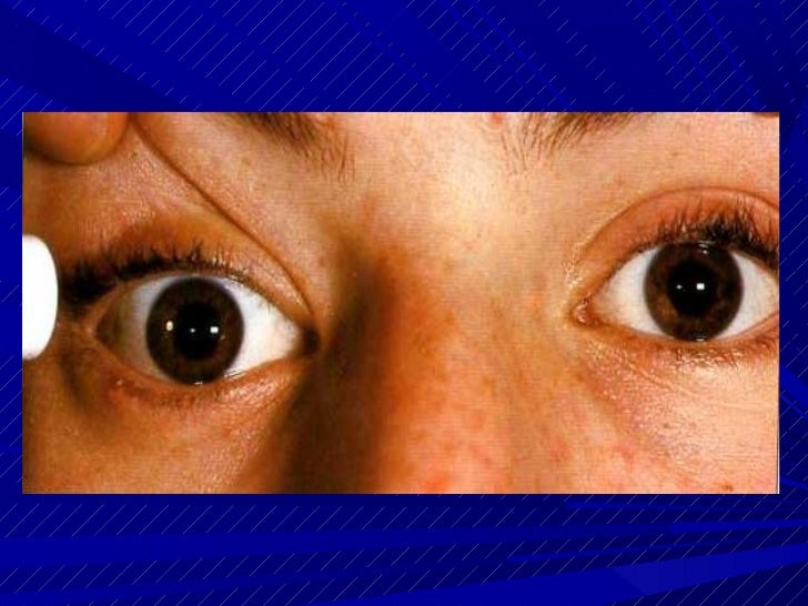 Neuropatia optica hebd