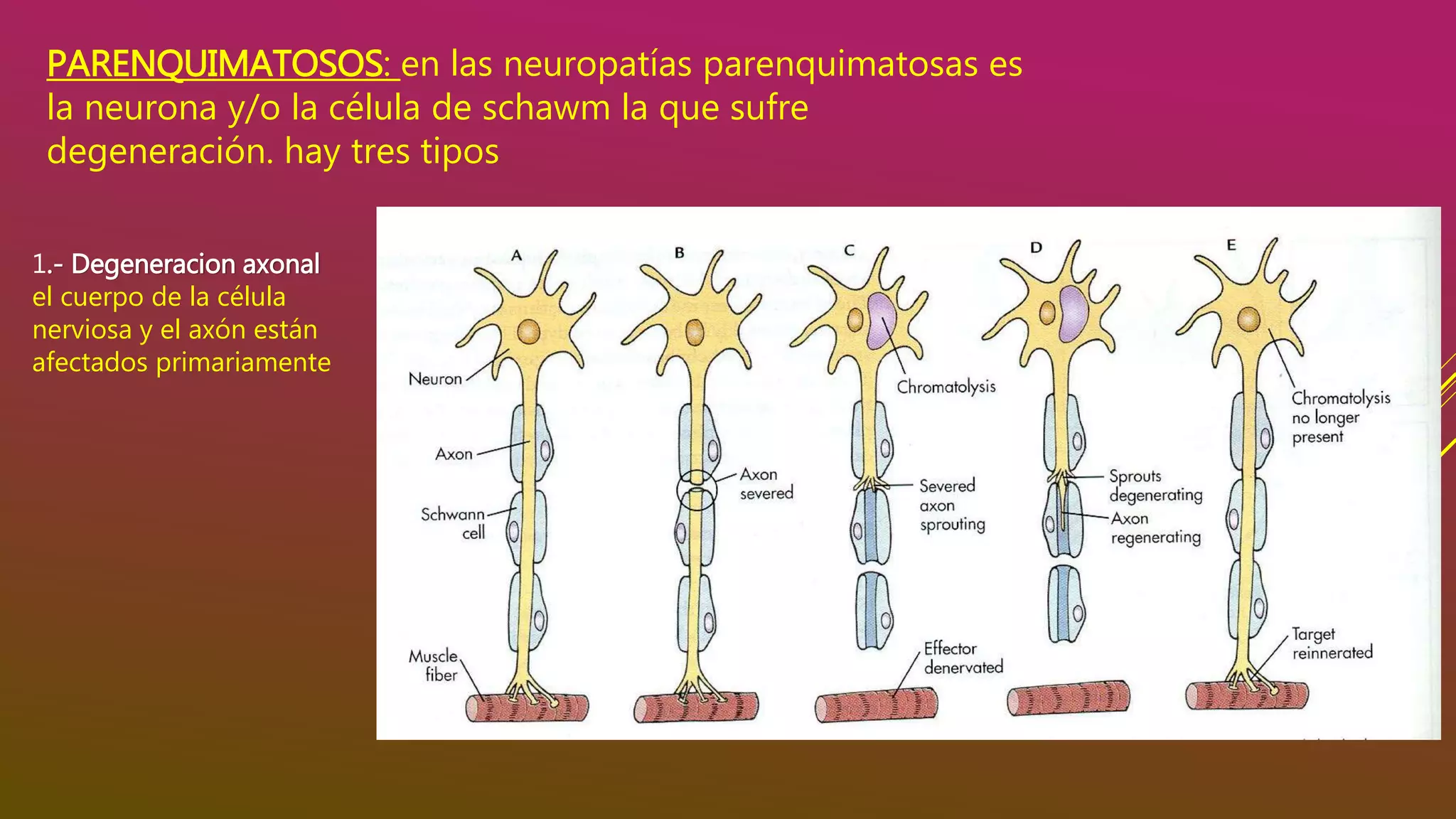 Neuropatias perifericas | PPT