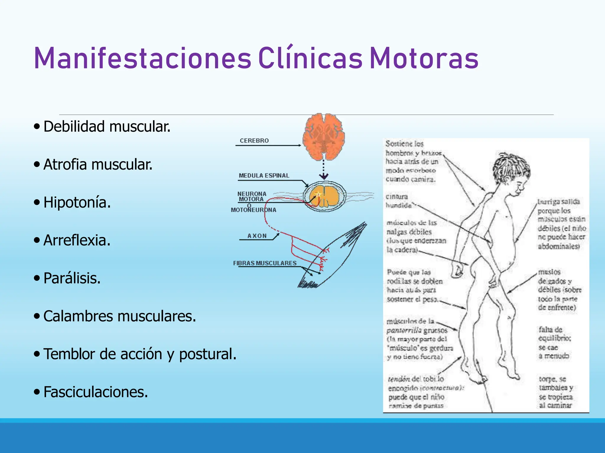 Neuropatias Perifericas, sindrome de Guillain Barre y neuropatia ...
