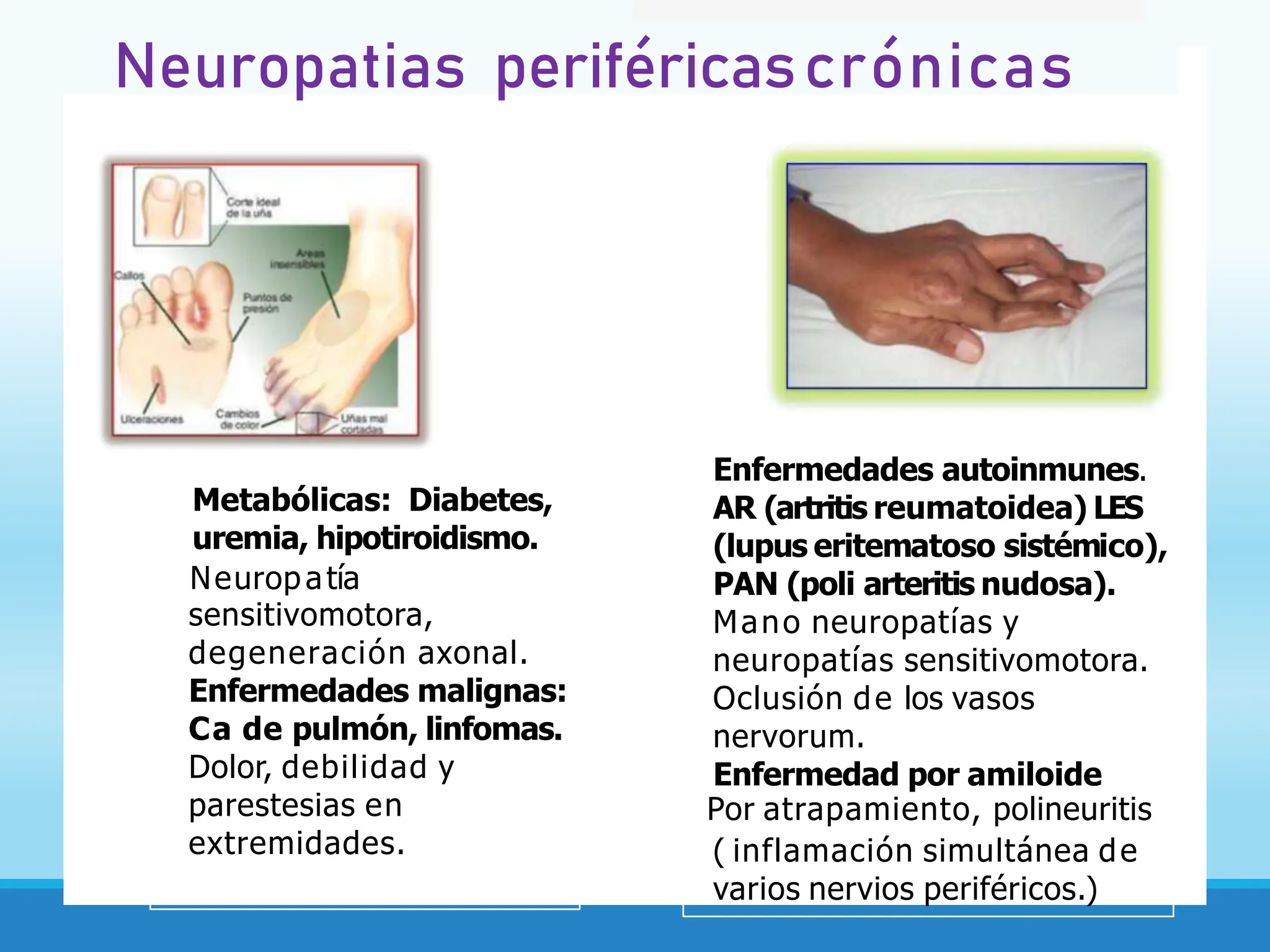 Neuropatias Perifericas, sindrome de Guillain Barre y neuropatia ...