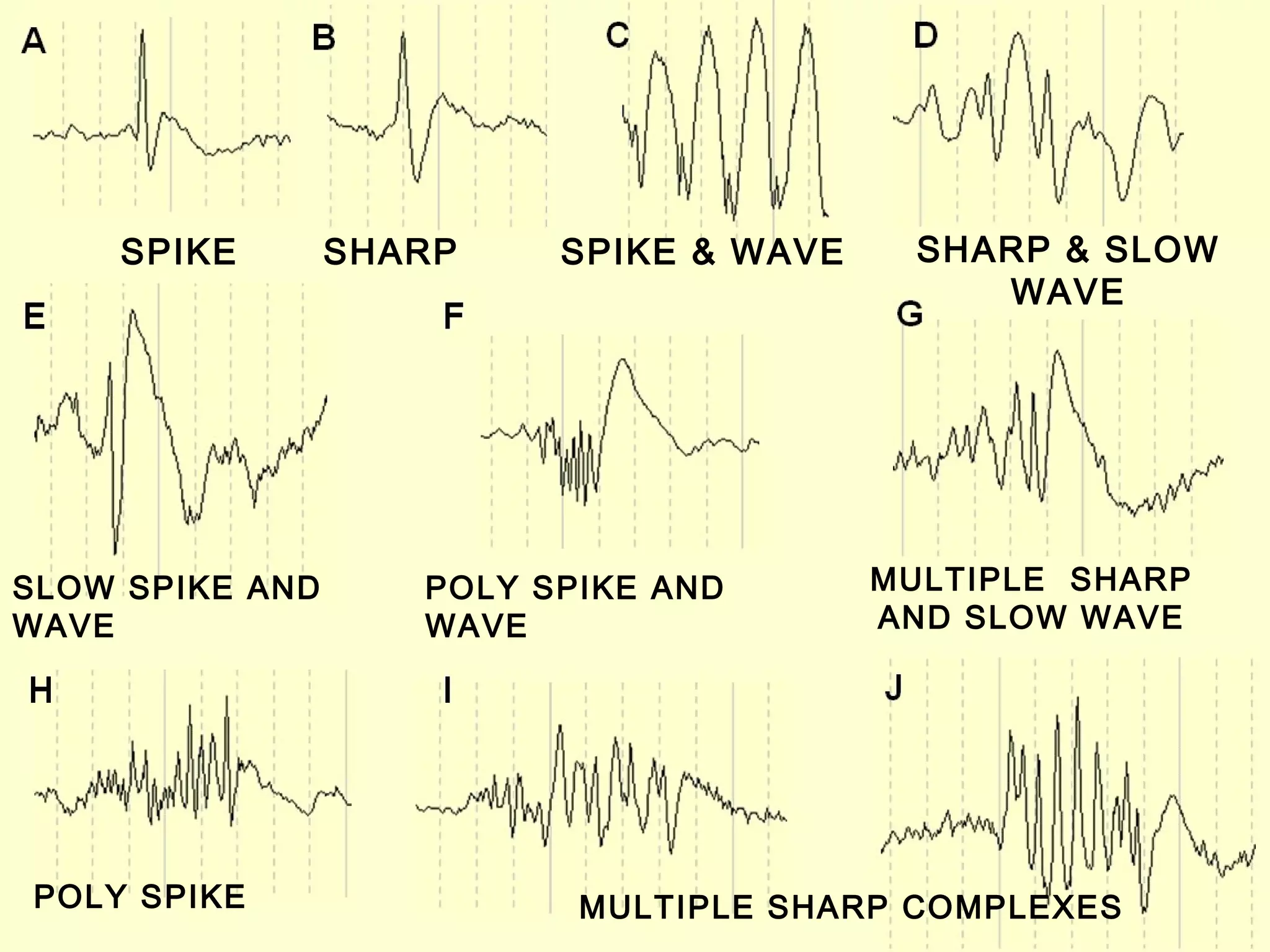 Neuro physiology of seizures & eeg, pedaitric neurologist, dr amit ...