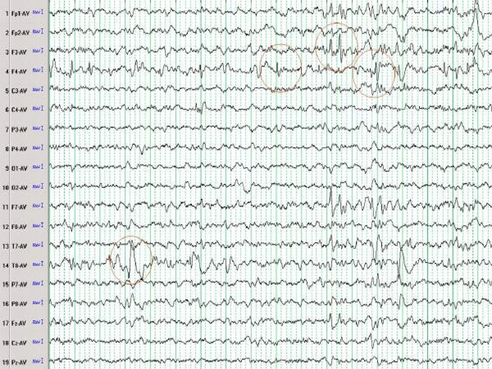 Neuro physiology of seizures & eeg, pedaitric neurologist, dr amit ...