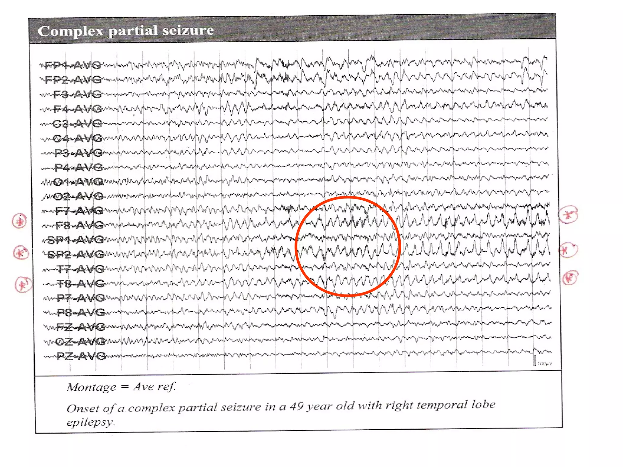 Neuro physiology of seizures & eeg, pedaitric neurologist, dr amit ...