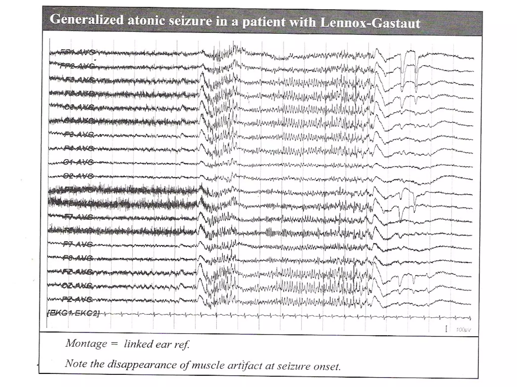 Neuro physiology of seizures & eeg, pedaitric neurologist, dr amit ...