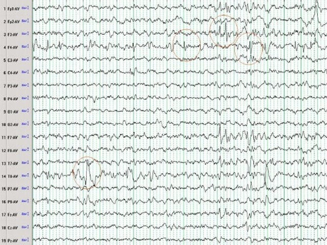 Neuro physiology of seizures & eeg, pedaitric neurologist, dr amit ...