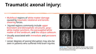 Neuropsychiatric consequences of traumatic brain injury | PPTX