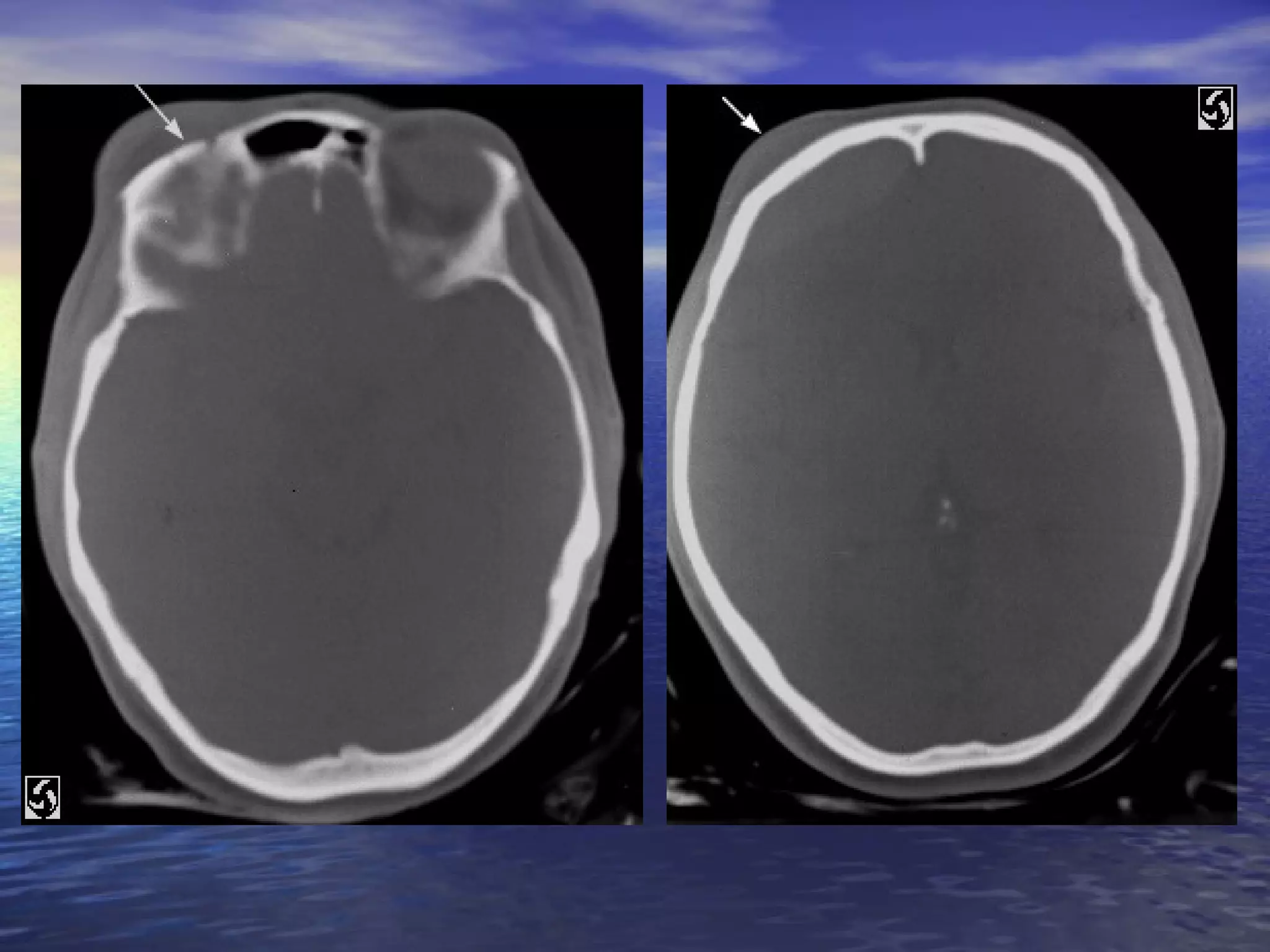 Neuroradiology Head Trauma | PPT