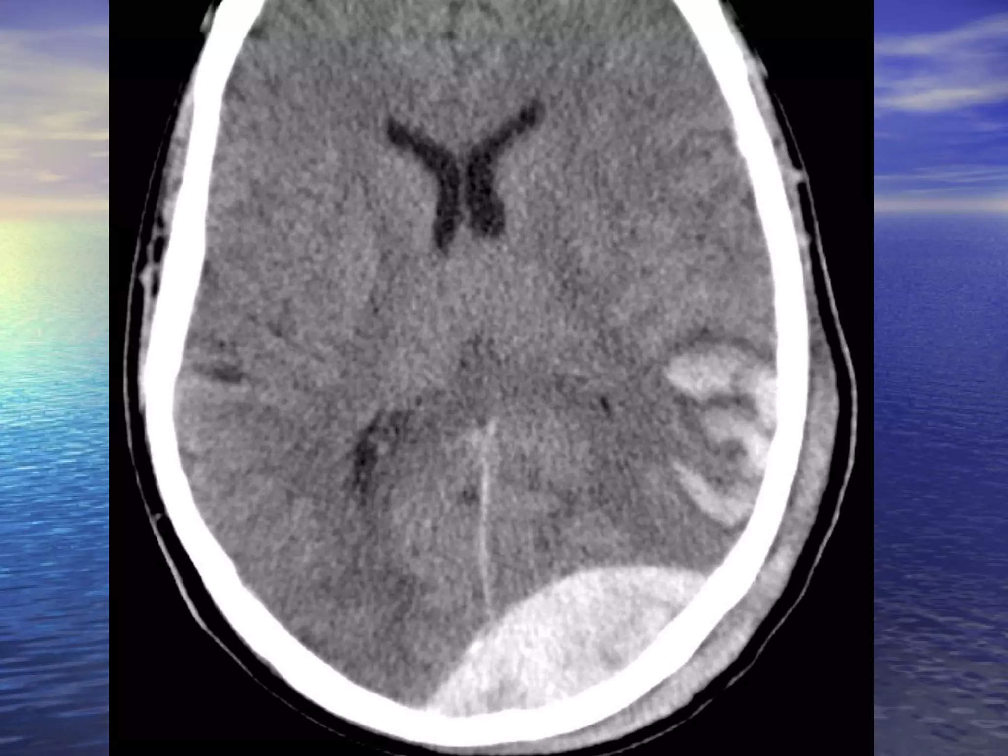 Neuroradiology Head Trauma | PPT