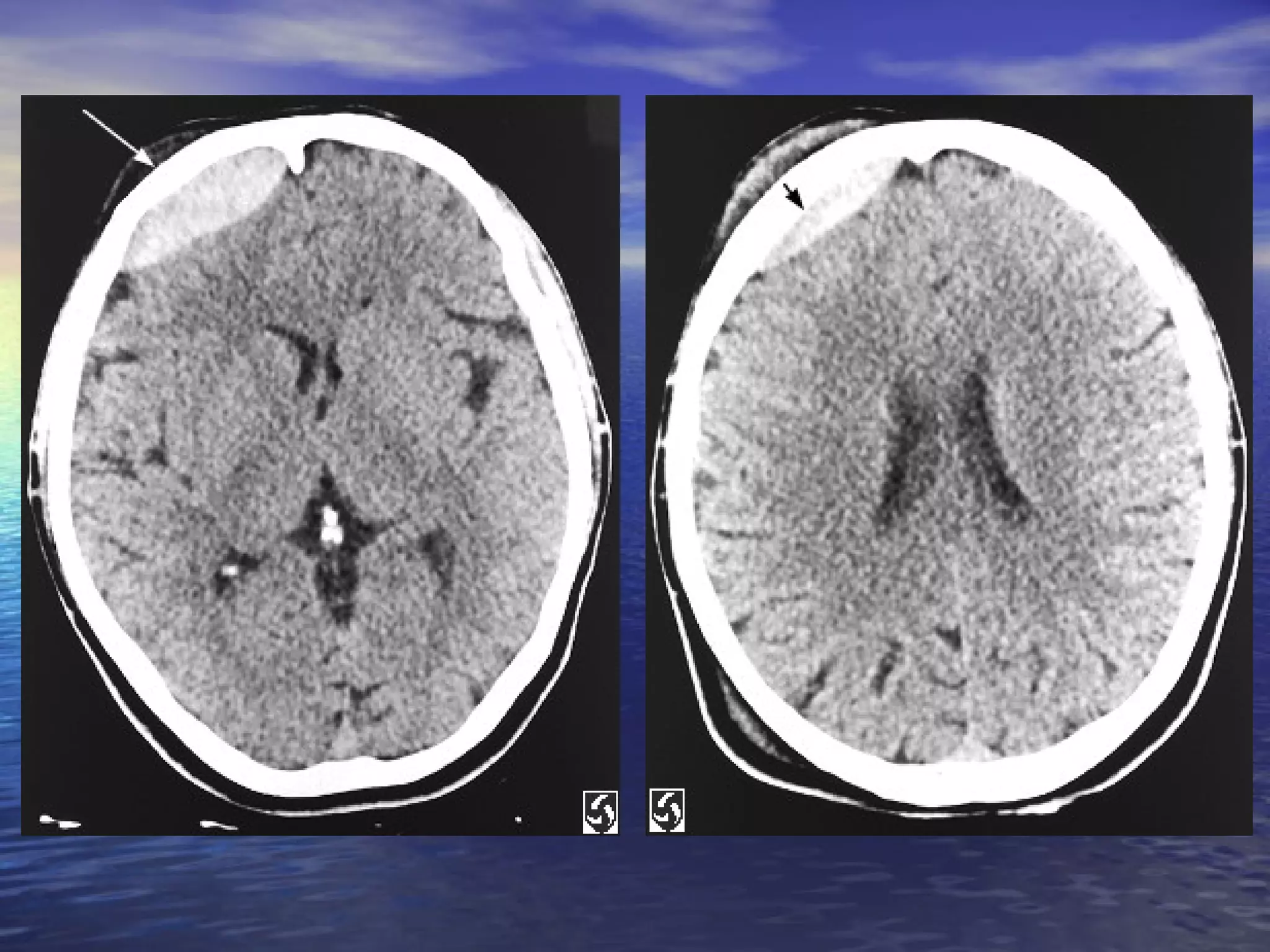 Neuroradiology Head Trauma | PPT
