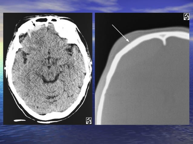 Neuroradiology Head Trauma | PPT