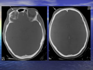 Neuroradiology Head Trauma | PPT
