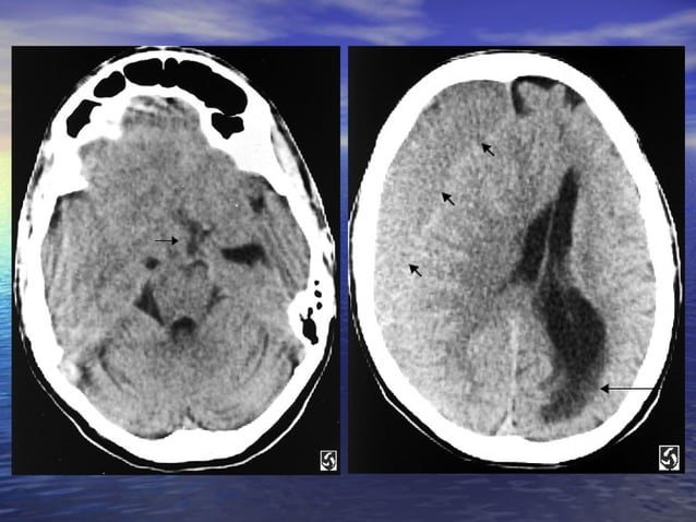 Neuroradiology Head Trauma | PPT