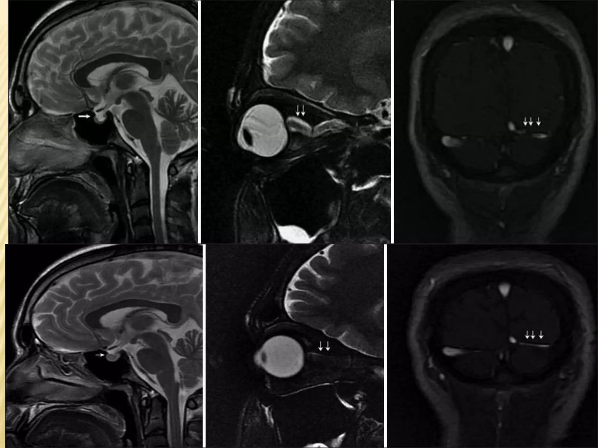Neuroradiology of idopathic Intracranial Hypertension | PPTX