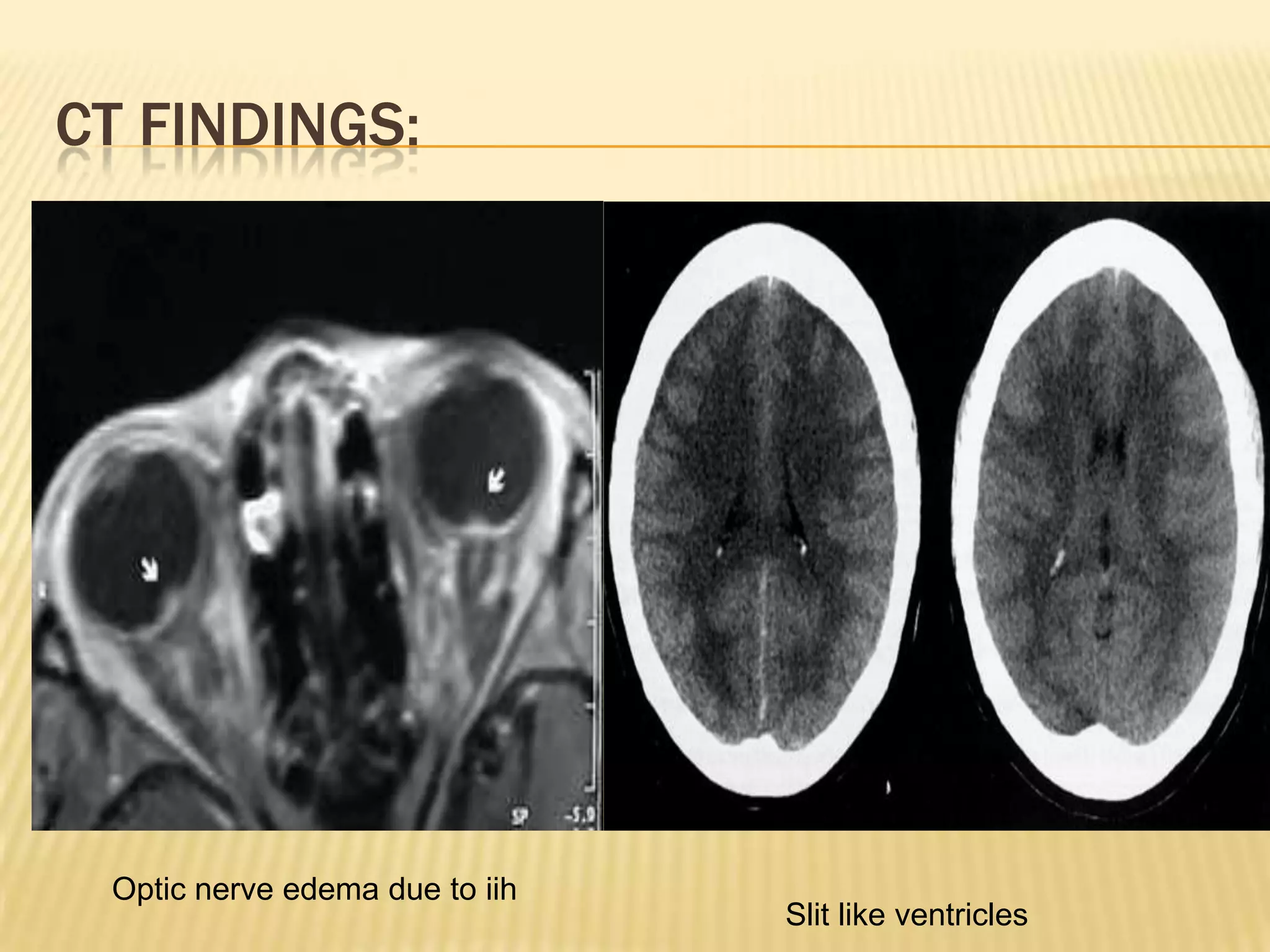 Neuroradiology of idopathic Intracranial Hypertension | PPTX