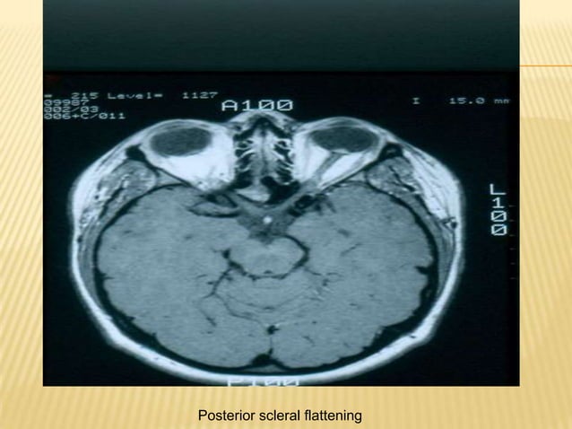 Neuroradiology of idopathic Intracranial Hypertension | PPTX