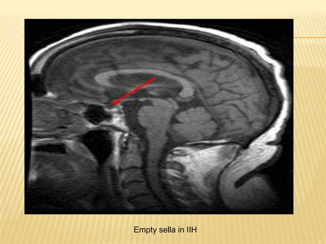 Neuroradiology of idopathic Intracranial Hypertension | PPTX