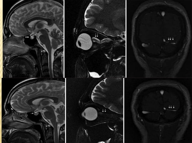 Neuroradiology of idopathic Intracranial Hypertension | PPTX