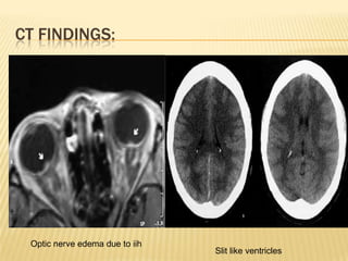 Neuroradiology of idopathic Intracranial Hypertension | PPTX