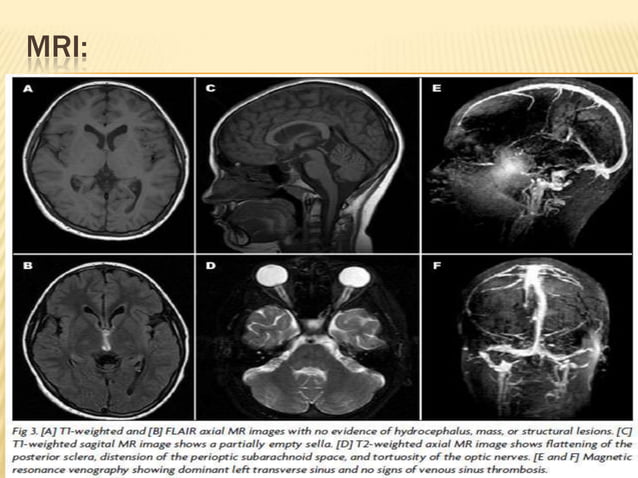Neuroradiology of idopathic Intracranial Hypertension | PPTX
