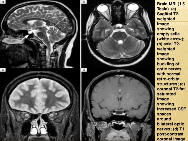 Neuroradiology of idopathic Intracranial Hypertension