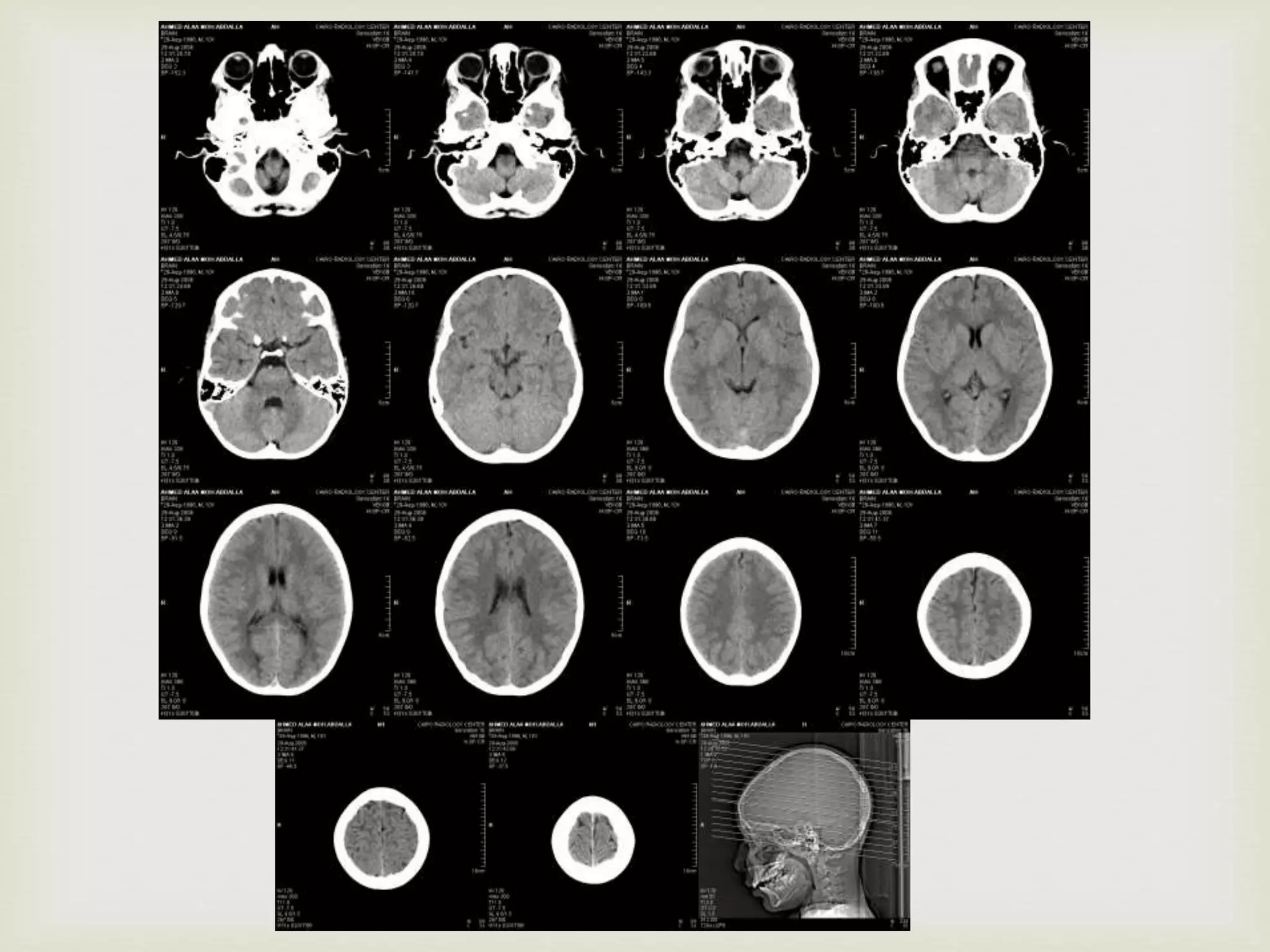 Neuro radiology neuroimaging | PPTX