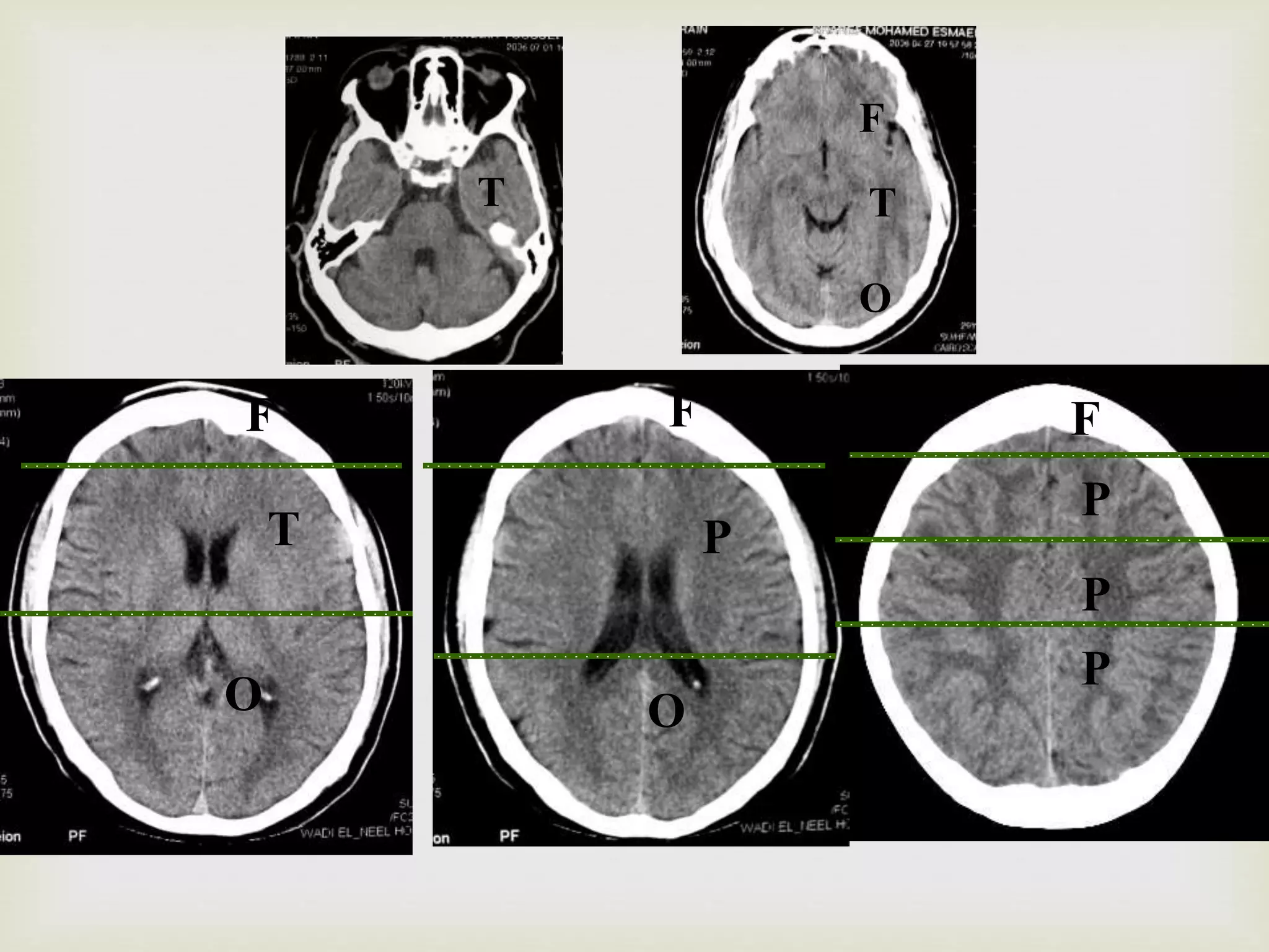 Neuro radiology neuroimaging | PPTX
