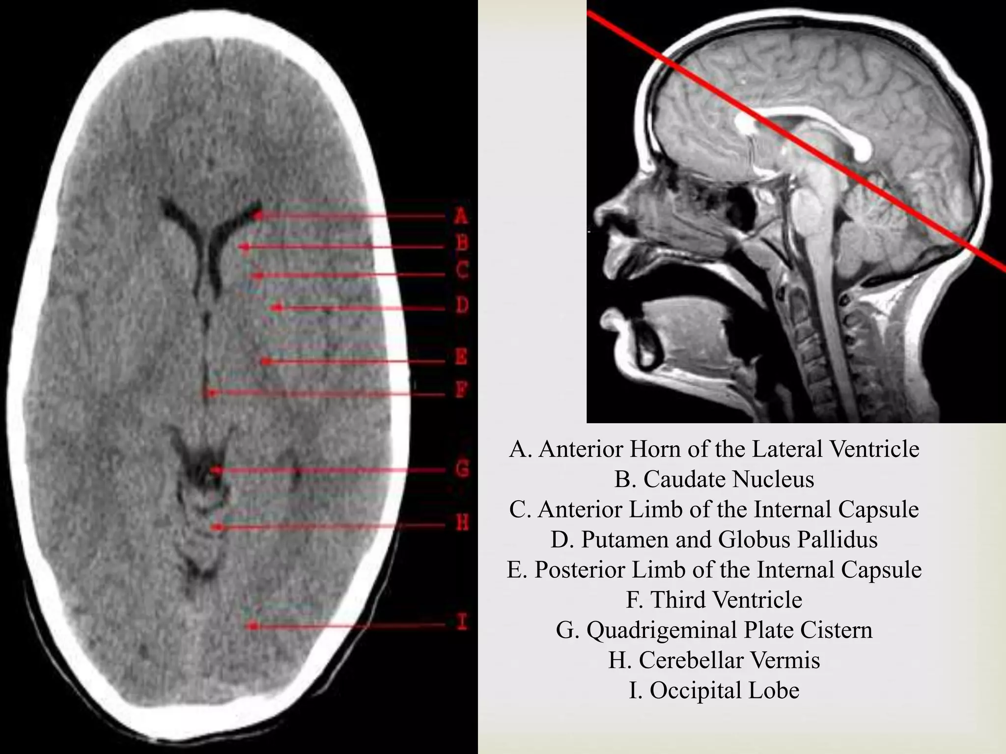 Neuro radiology neuroimaging | PPTX