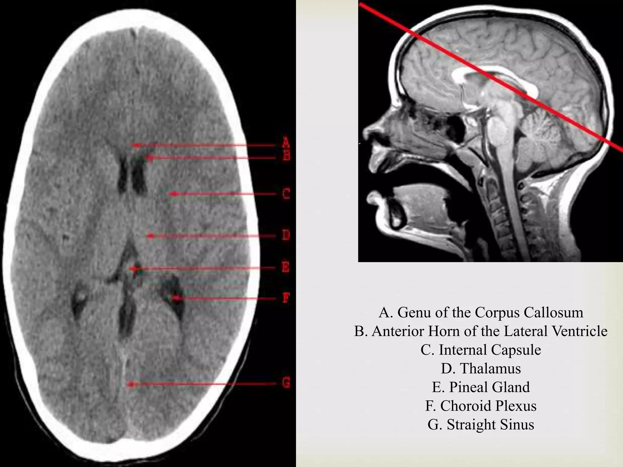 Neuro radiology neuroimaging | PPTX