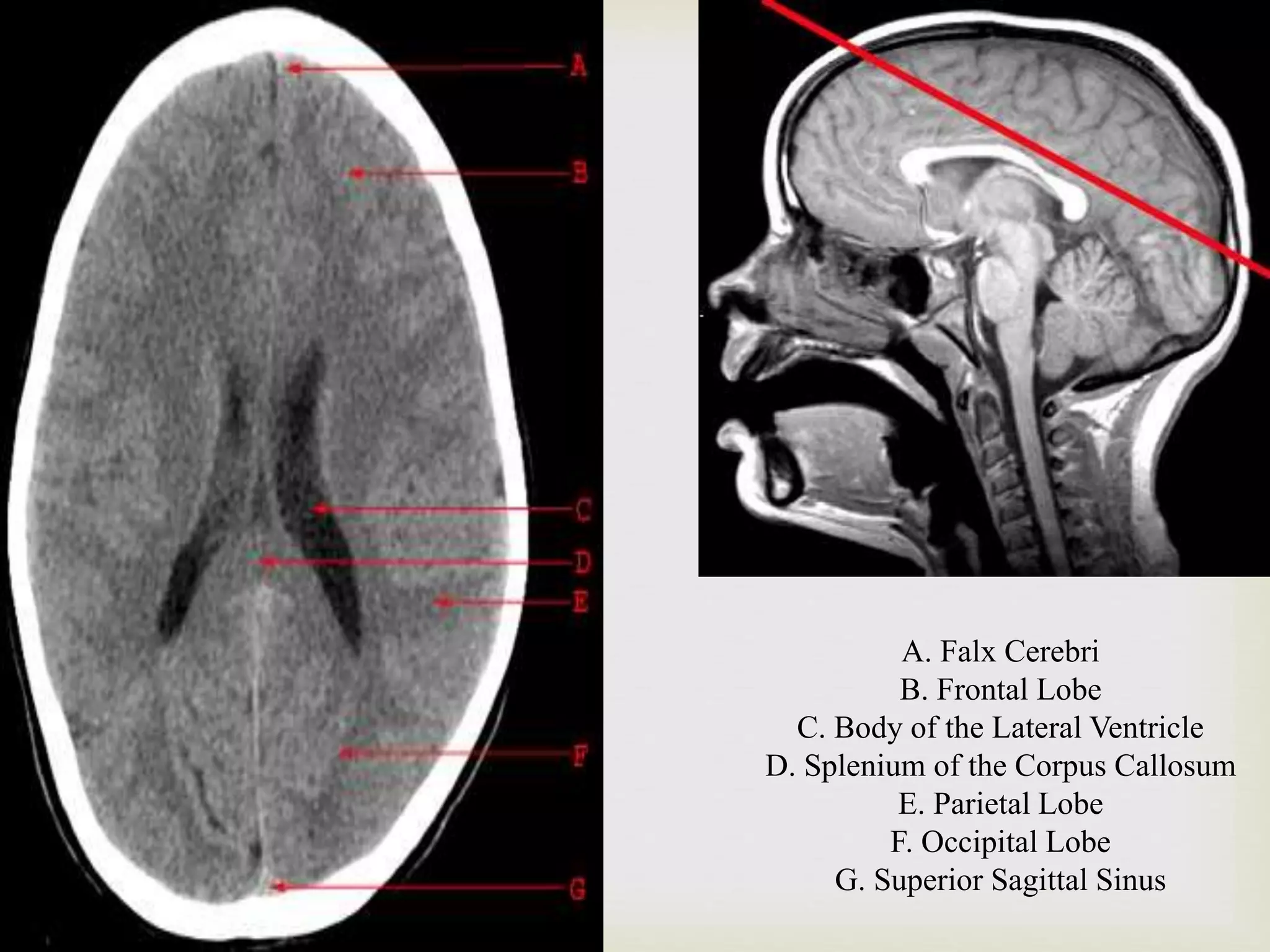 Neuro radiology neuroimaging | PPTX