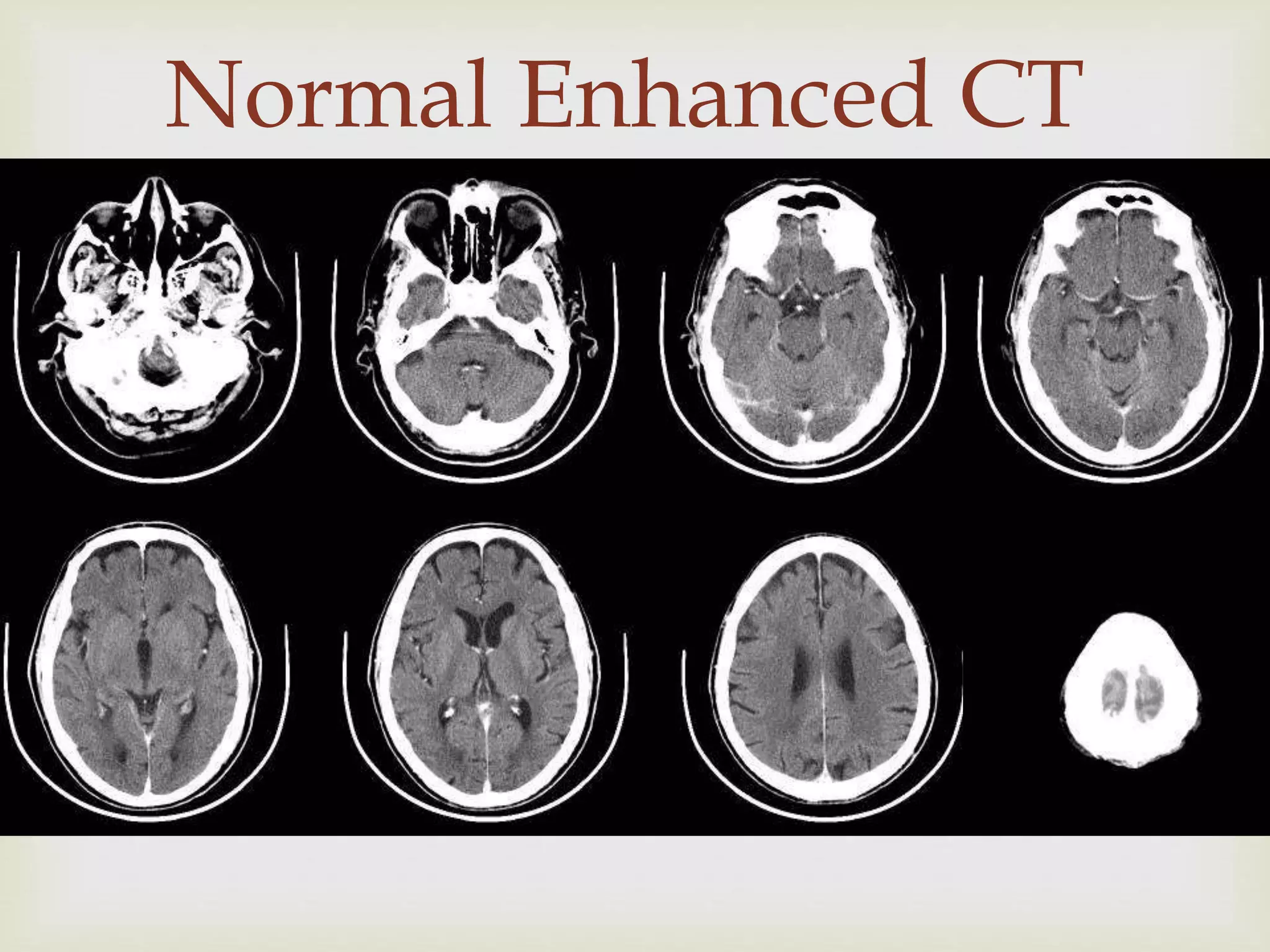 Neuro radiology neuroimaging | PPTX