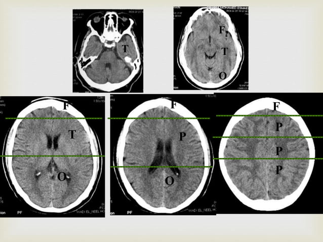 Neuro radiology neuroimaging | PPTX