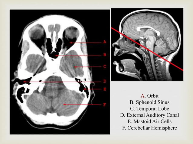 Neuro radiology neuroimaging | PPTX