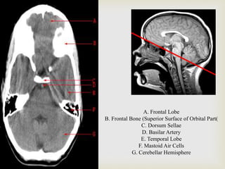 Neuro radiology neuroimaging | PPTX