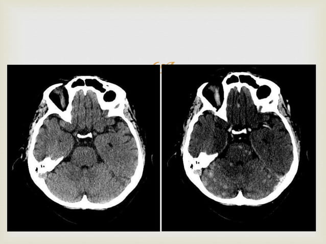 Neuro radiology neuroimaging | PPTX