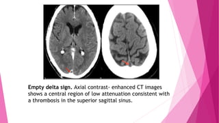 Neuroradiology 1a | PDF