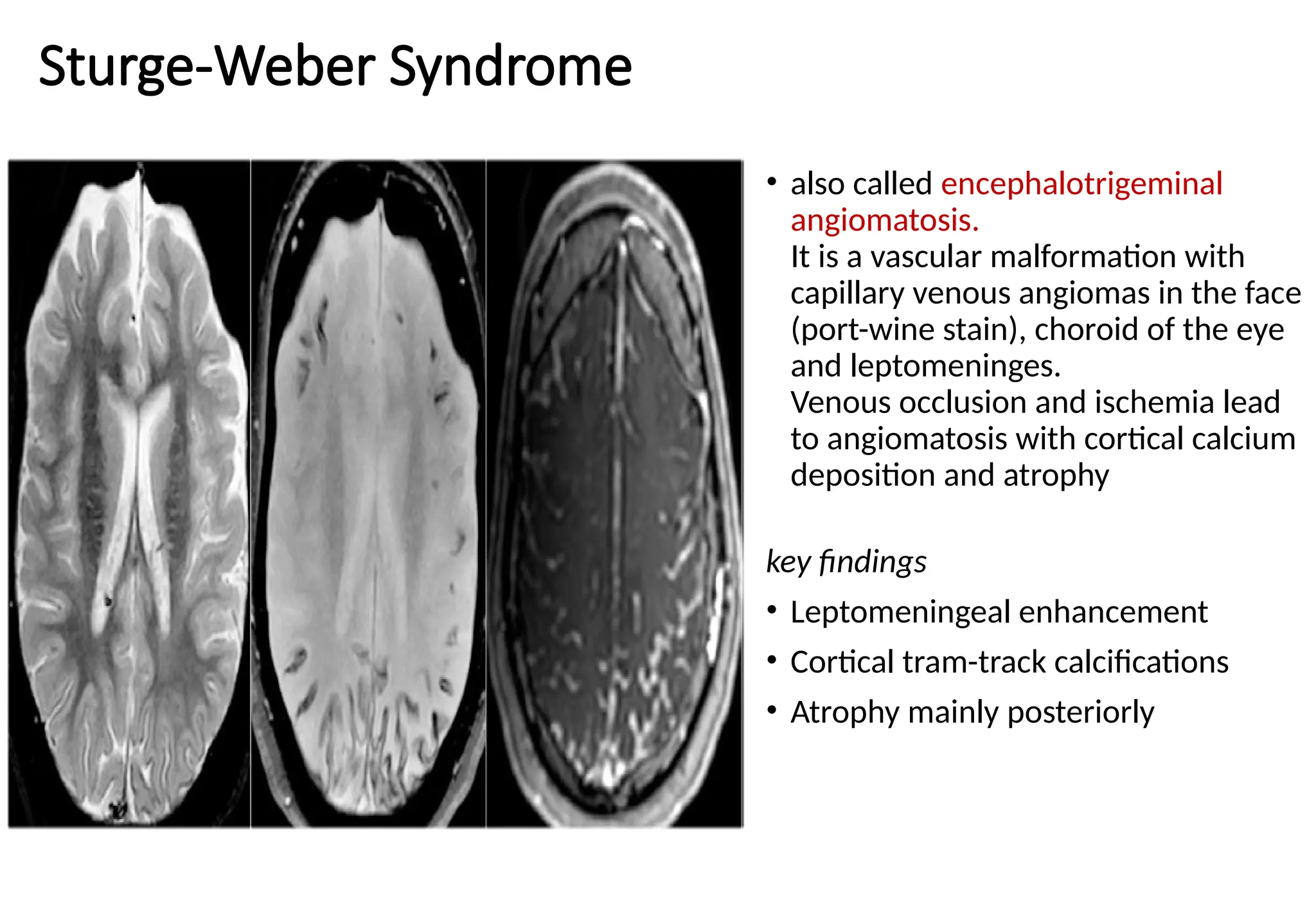 NEURORADIOLOGY EPILEPSY.pptx ppt on neuroradiology epilespsy | PPT