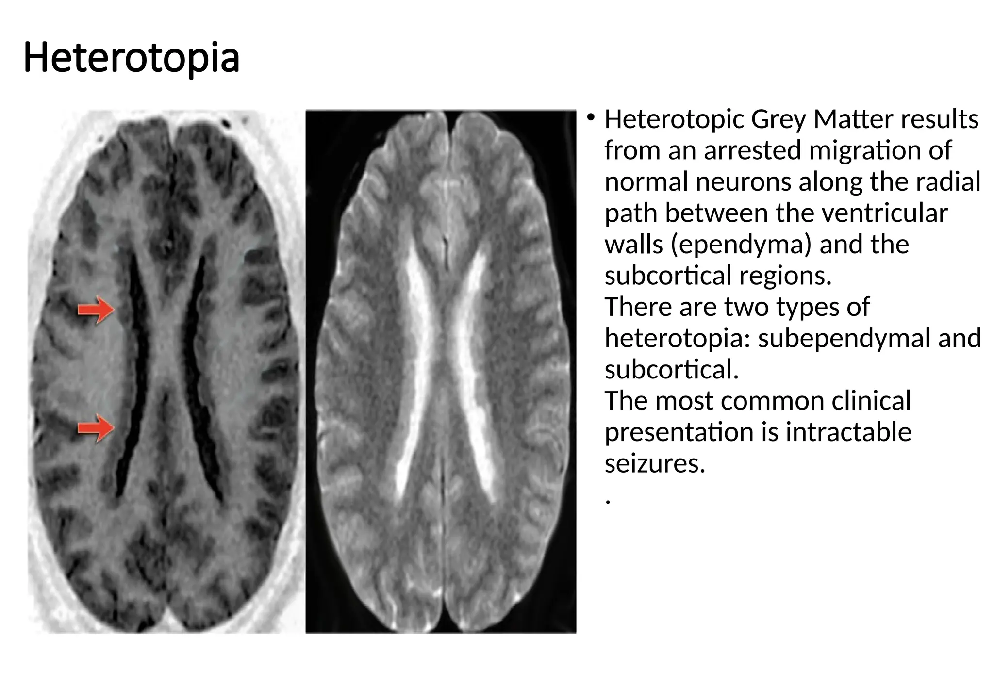 NEURORADIOLOGY EPILEPSY.pptx ppt on neuroradiology epilespsy | PPT