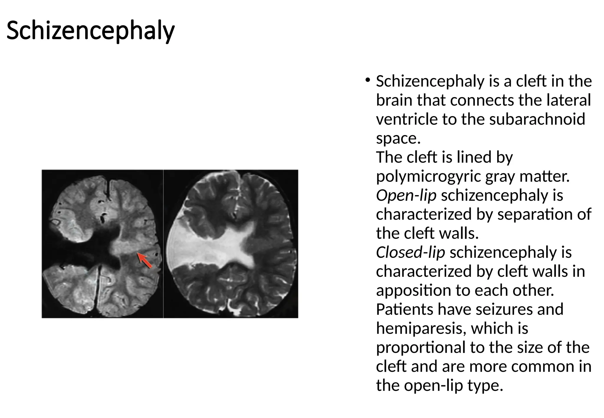 NEURORADIOLOGY EPILEPSY.pptx ppt on neuroradiology epilespsy | PPT