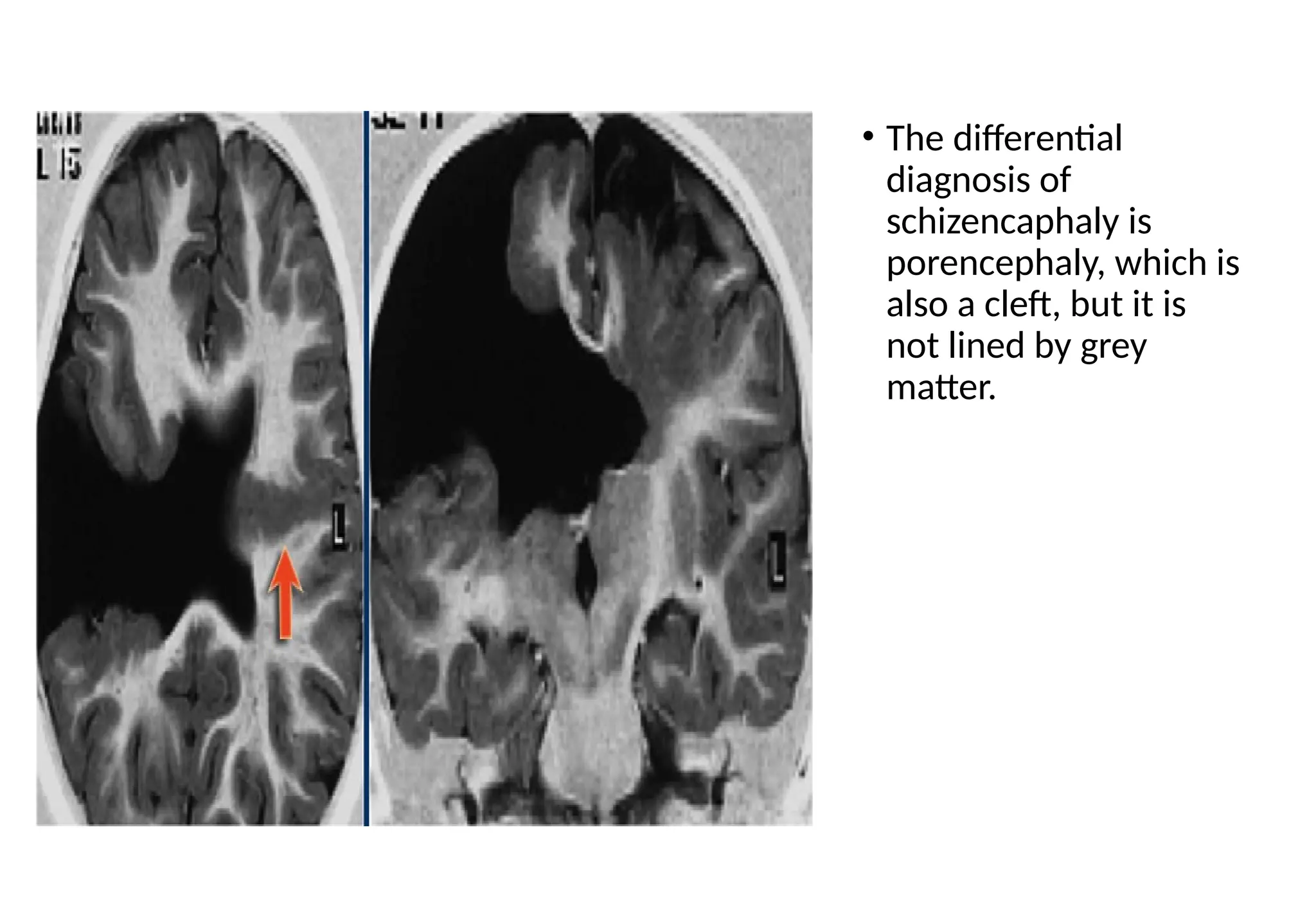 NEURORADIOLOGY EPILEPSY.pptx ppt on neuroradiology epilespsy | PPT