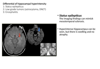 NEURORADIOLOGY EPILEPSY.pptx ppt on neuroradiology epilespsy | PPT