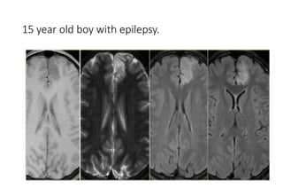NEURORADIOLOGY EPILEPSY.pptx ppt on neuroradiology epilespsy | PPT
