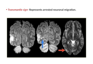 NEURORADIOLOGY EPILEPSY.pptx ppt on neuroradiology epilespsy | PPT